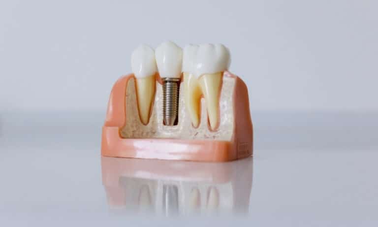 What are the best options for replacing a missing tooth?