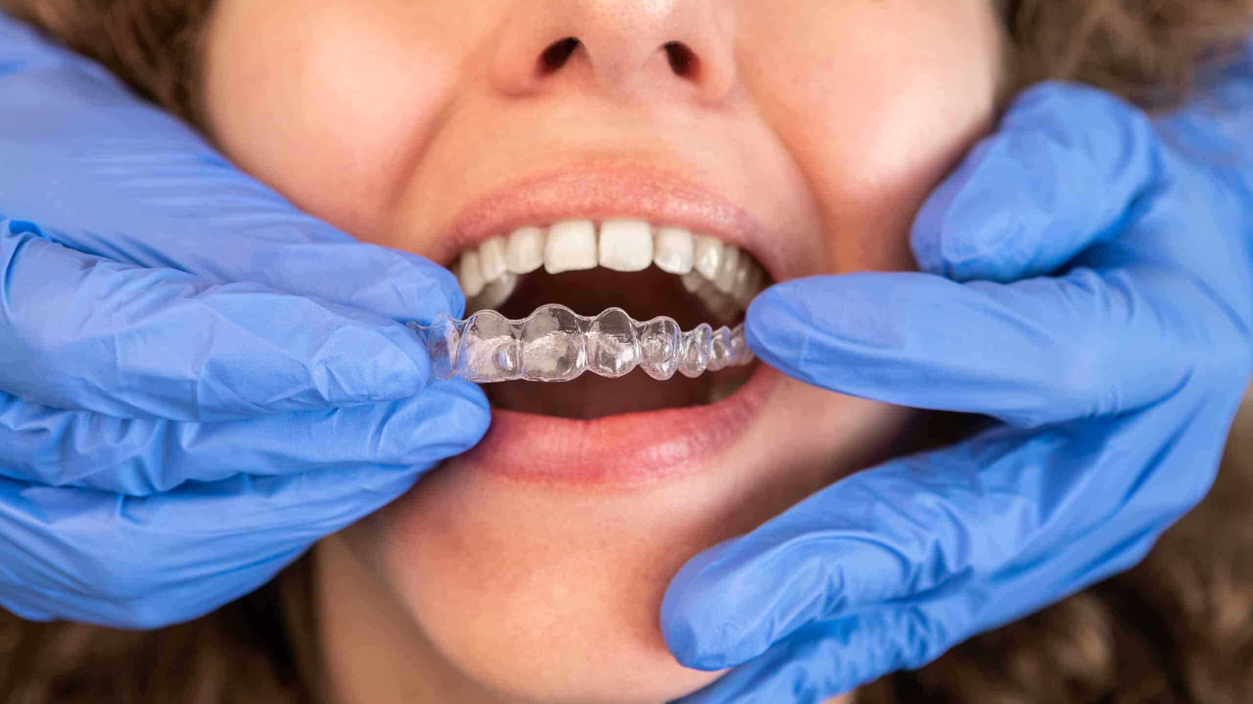 Fixing an Overbite: Can Invisalign Do It?